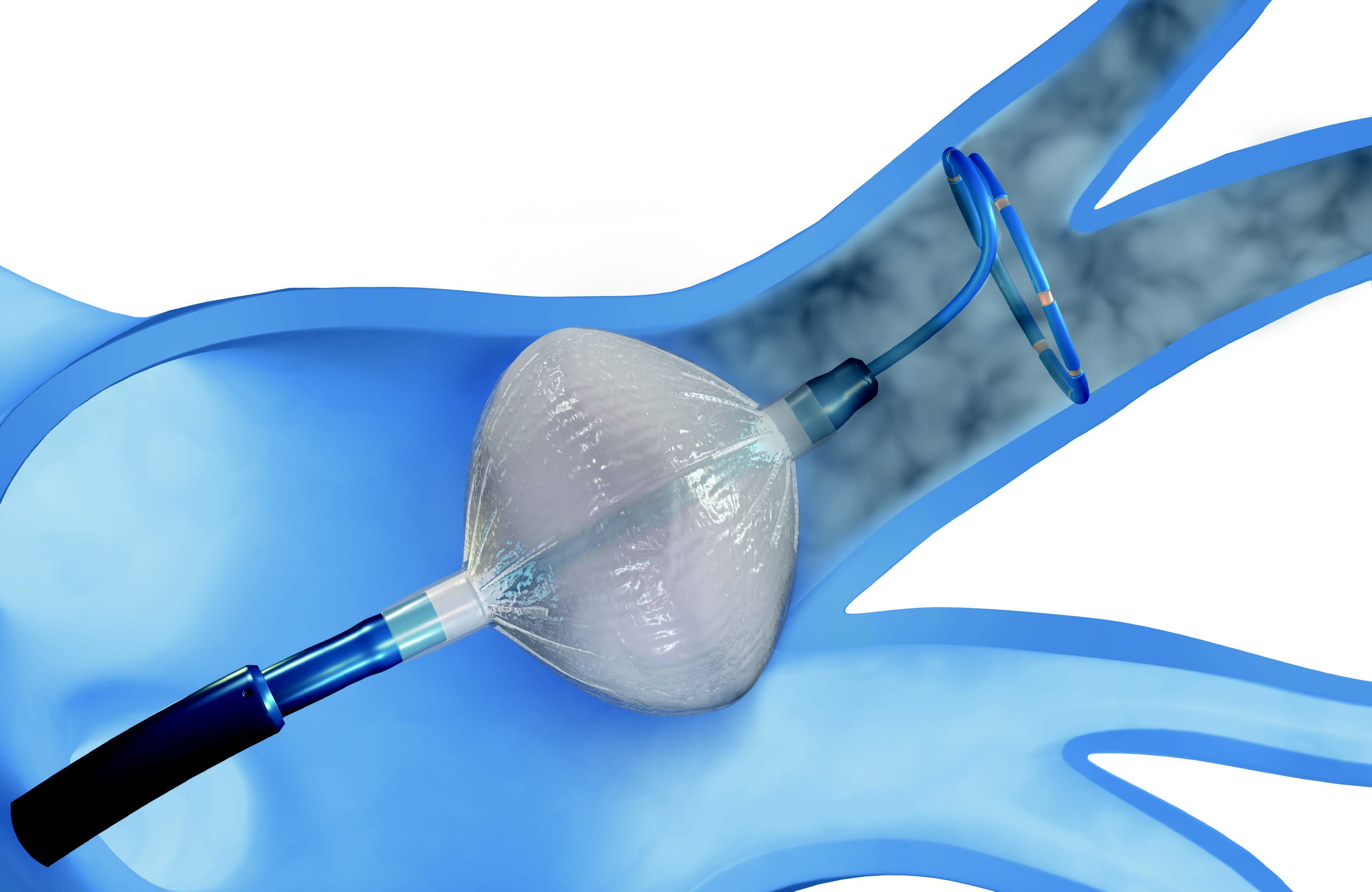 Minimal-invasive Katheterablation (Kälteablation) bei Vorhofflimmern ...